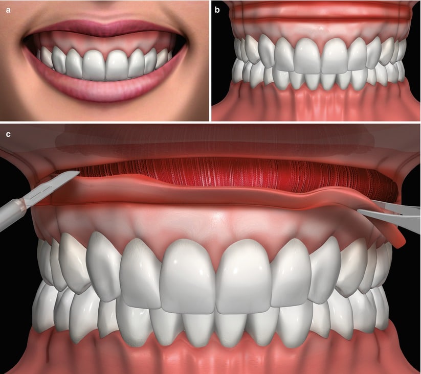 Crown Lengthening Melbourne Family Dentist